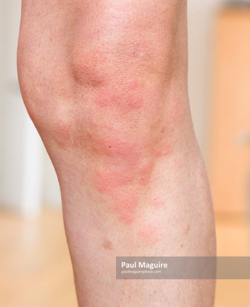 Stock photo - Hives rash (urticaria), skin condition, skin allergy on ...